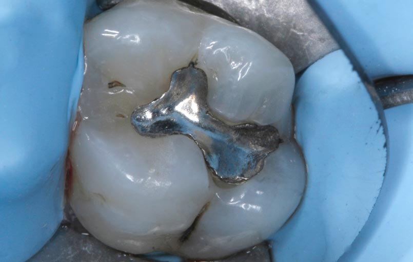 AMALGAMA DENTALE | Studiodontoiatrico Zini e Associati