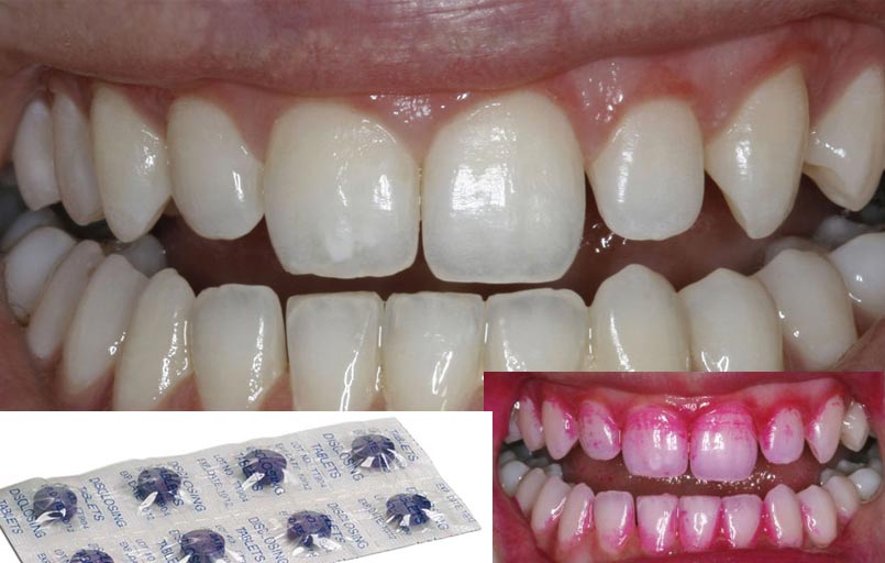 I RIVELATORI DI PLACCA | Studiodontoiatrico Zini e Associati