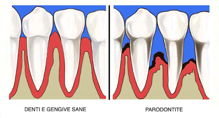 Parodontite: quali sono sintomi e i trattamenti possibili ...